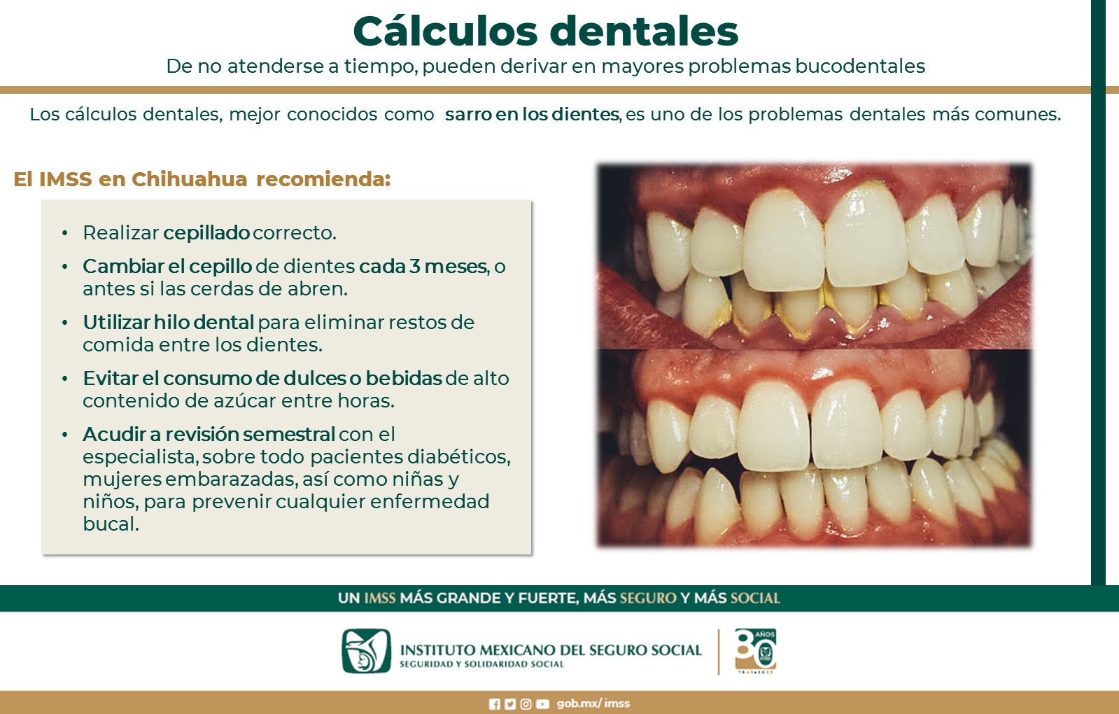 Advierte IMSS por los “cálculos dentales”, mejor conocido como “sarro ...
